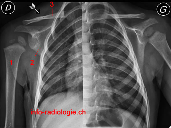 Fracture de la clavicule (enfant)