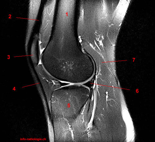 IRM du genou: coupes sagittales T2fatsat