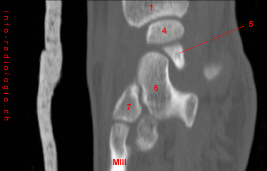 Coupes sagittales (tomodensitométrie) du poignet