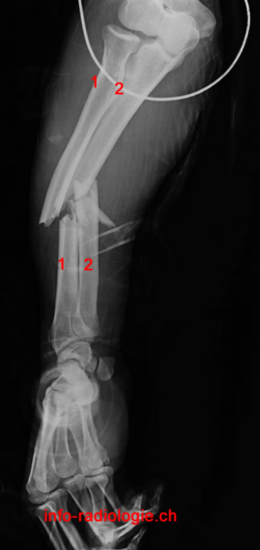 Fracture des deux os de l'avant-bras (adulte)