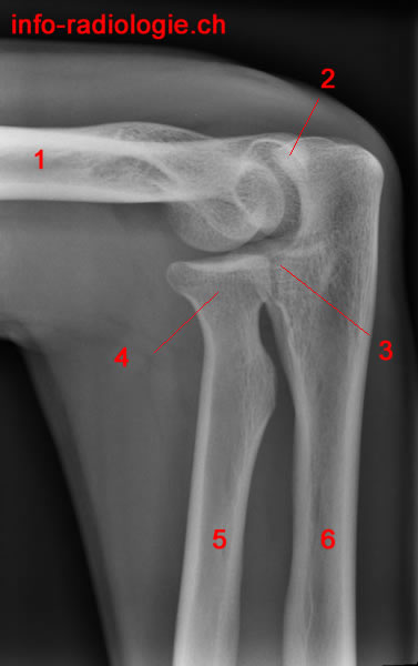 Fracture coronoïde ulna
