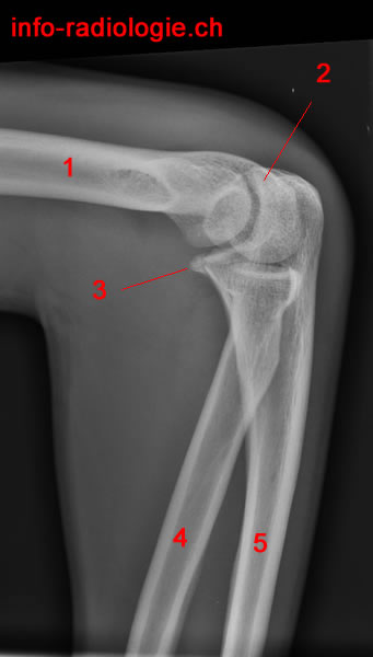 Fracture coronoïde ulna