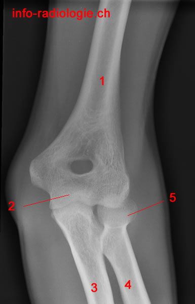 Fracture coronoïde ulna