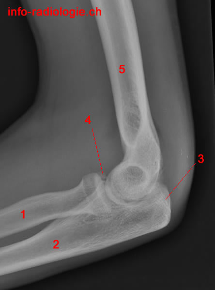 Fracture coronoïde ulna