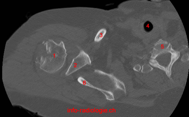 Fracture de l'humérus proximal (scanner)