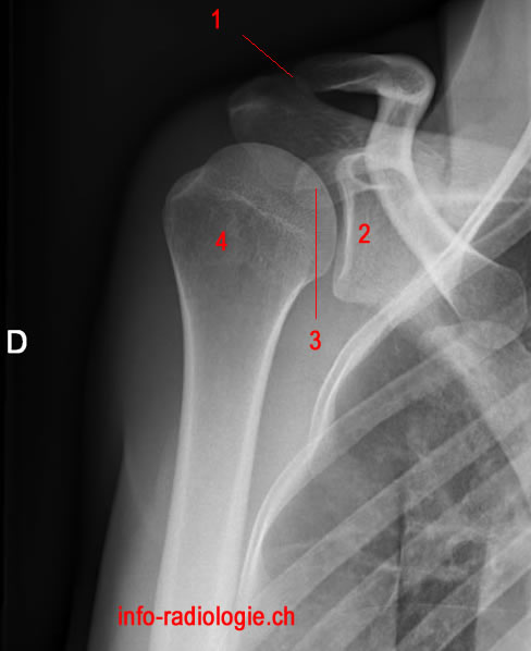 Fracture de la scaplula (omoplate)